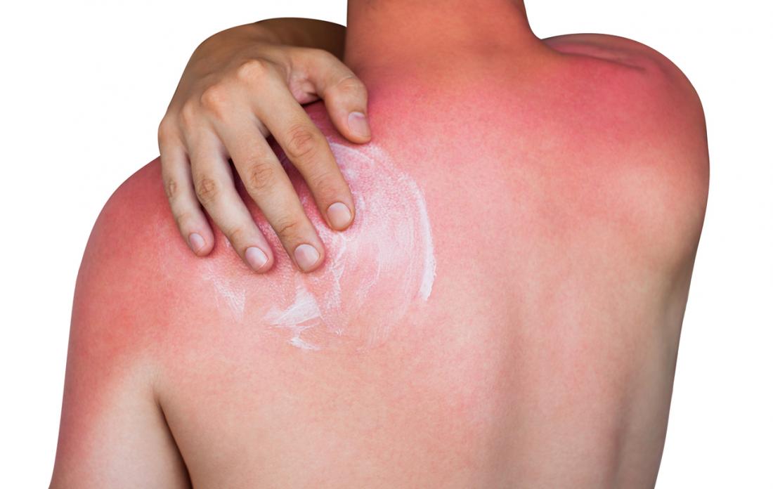 How to Treat a Sunburn